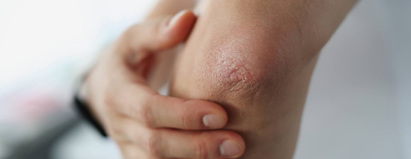 La mejor crema para codos secos: hidratación y cuidado