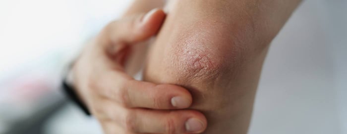 La mejor crema para codos secos: hidratación y cuidado