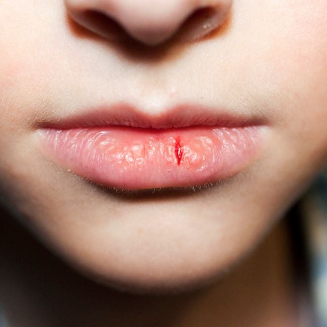 Hidratar Labios - Consejos, Remedios caseros & Productos